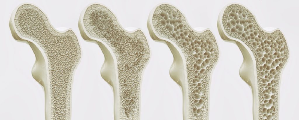 OSTEOPENIA - Symptoms, Causes, Risk Groups, Prevention and Treatment ...