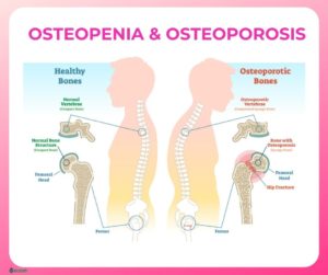 OSTEOPENIA - Symptoms, Causes, Risk Groups, Prevention and Treatment ...