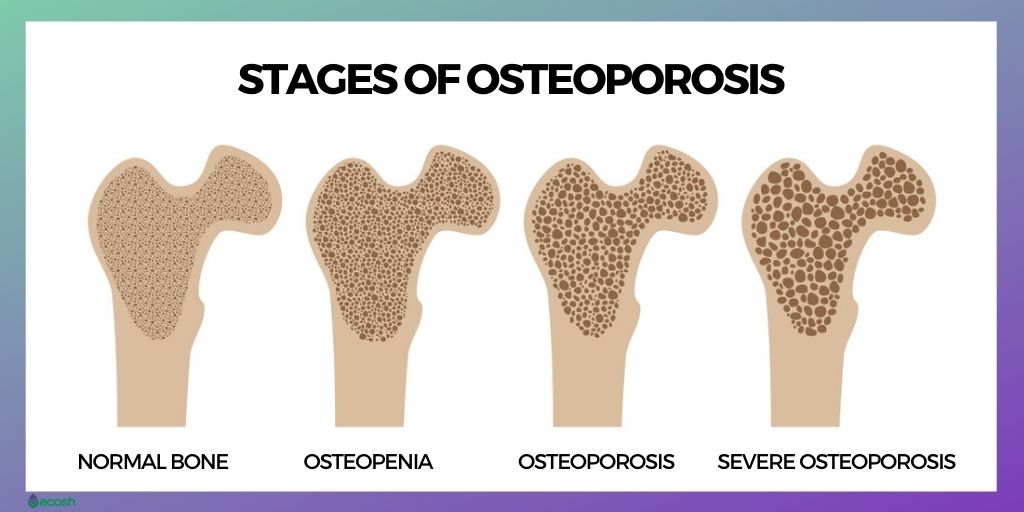 OSTEOPOROSIS Symptoms Causes Risk Groups Prevention And Treatment